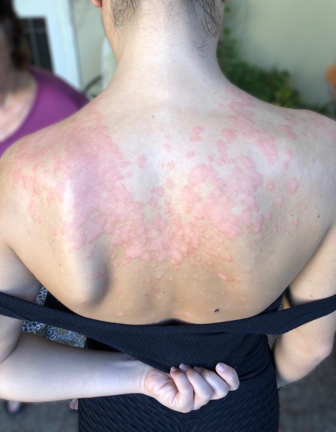 How I Overcame Psoriasis Naturally: A Personal Journey To Healing ...
